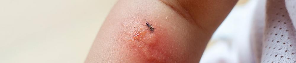About mosquito bites, allergic reactions, self-care, symptom